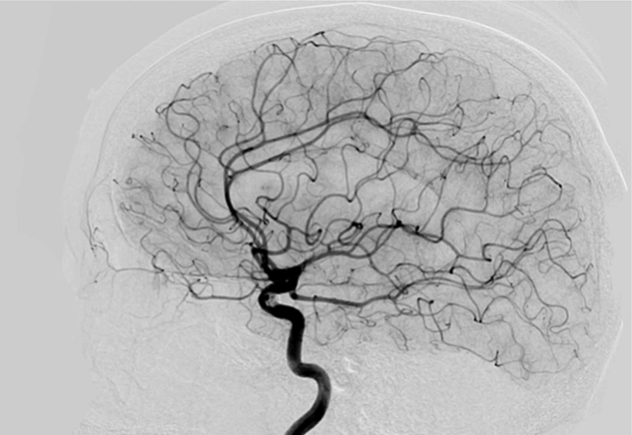 Venous Procedures | Vascular & Interventional Radiology QLD